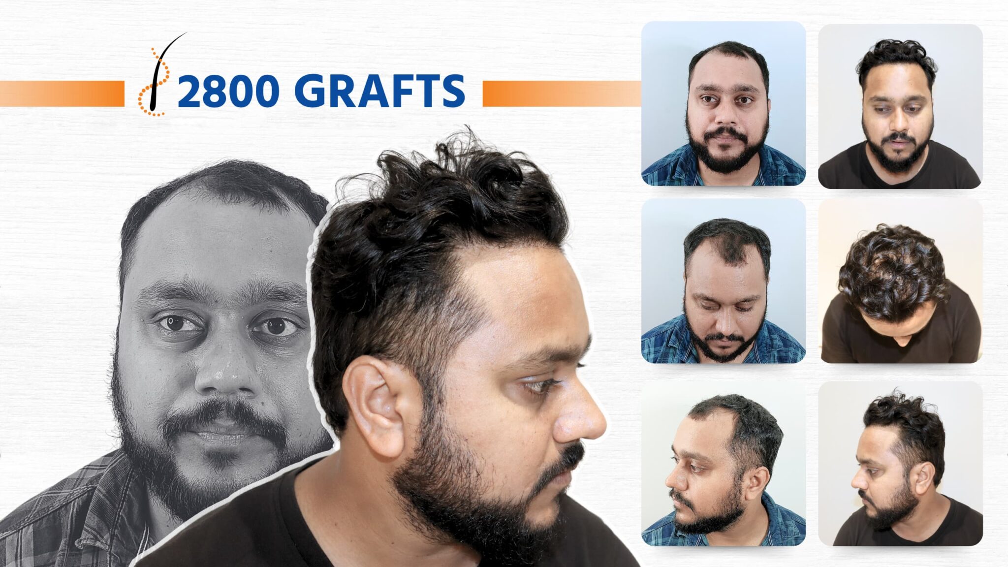 Best Hair Transplant Clinic | La Densitae Clinic – Do Not Compromise On ...